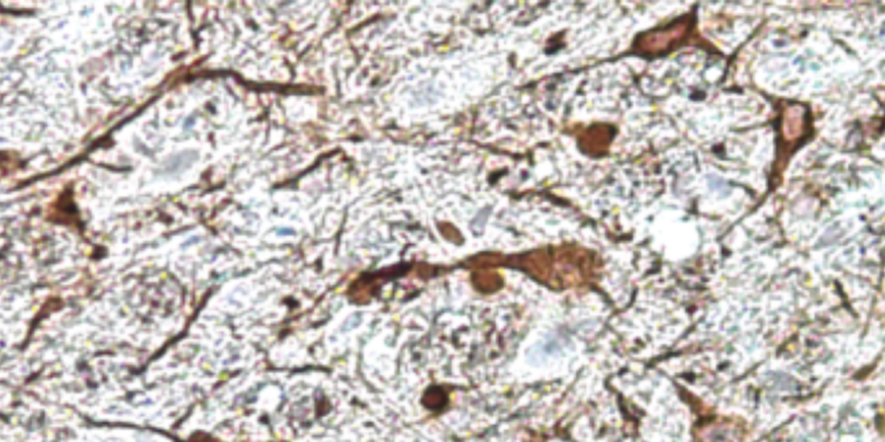 U of A lab targets clinical trials for Parkinson’s disease vaccine ...